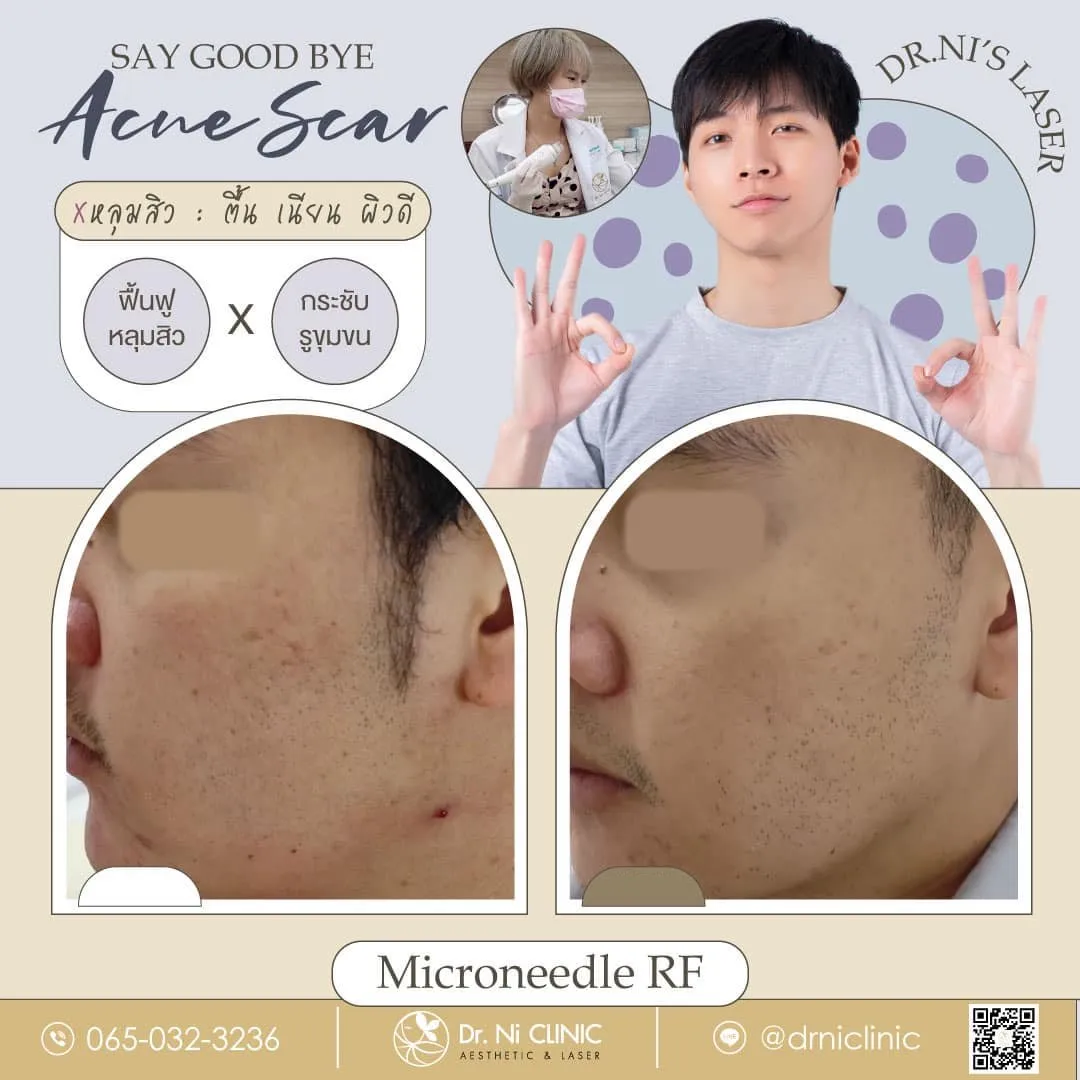 Fractional RF Microneedle - Dr. Ni CLINIC